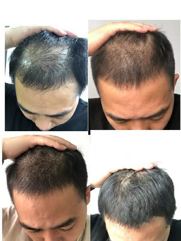 Plasma Electric Hair Growth Laser Comb Fda Approved Dandruff 650nm