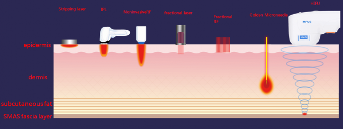 Peninsula Micro Ultra HIFU For Painless Face And Neck Skin Tighten And ...